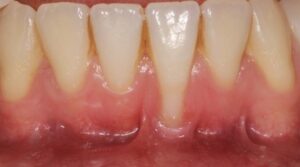 Treating Gingival Recession at Fulham Road Dental - Fulham Road Dental