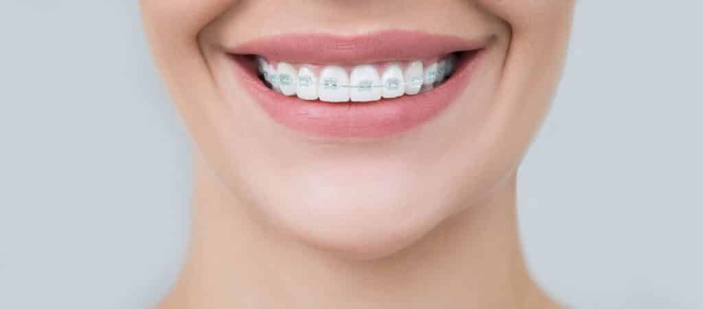 Do Teeth Move Back After Braces? | Fulham Road Dental